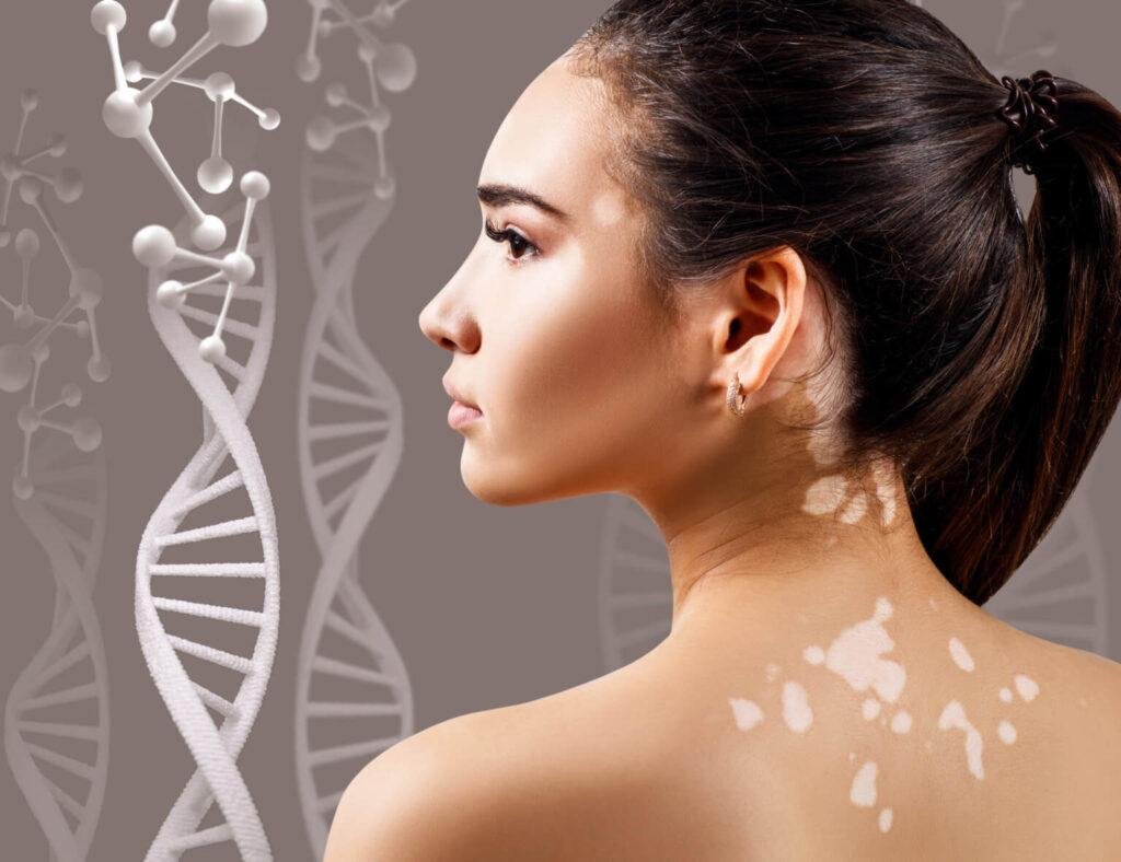 Vitiligo Treatment in Thane by Dr. Sharmila Patil | Leading ...