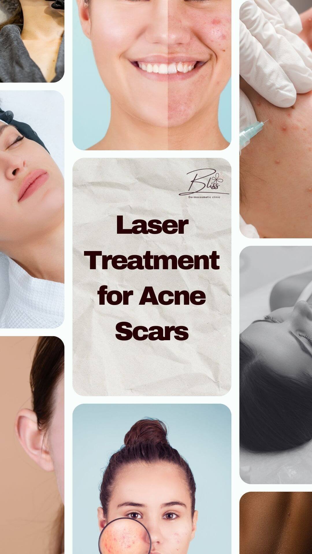 Laser Treatment for Acne Scars in Thane – drsharmilapatil
